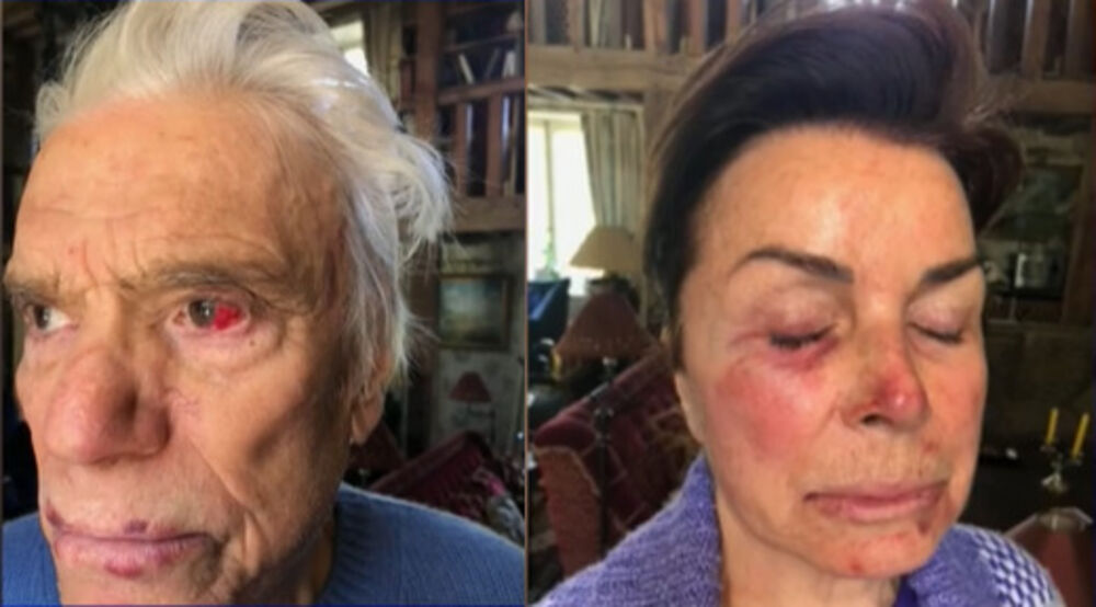 OBJAVLJENE SLIKE TAPIJA I SUPRUGE: Surovi provalnici su ih UNAKAZILI, lica su im sva u podlivima ...