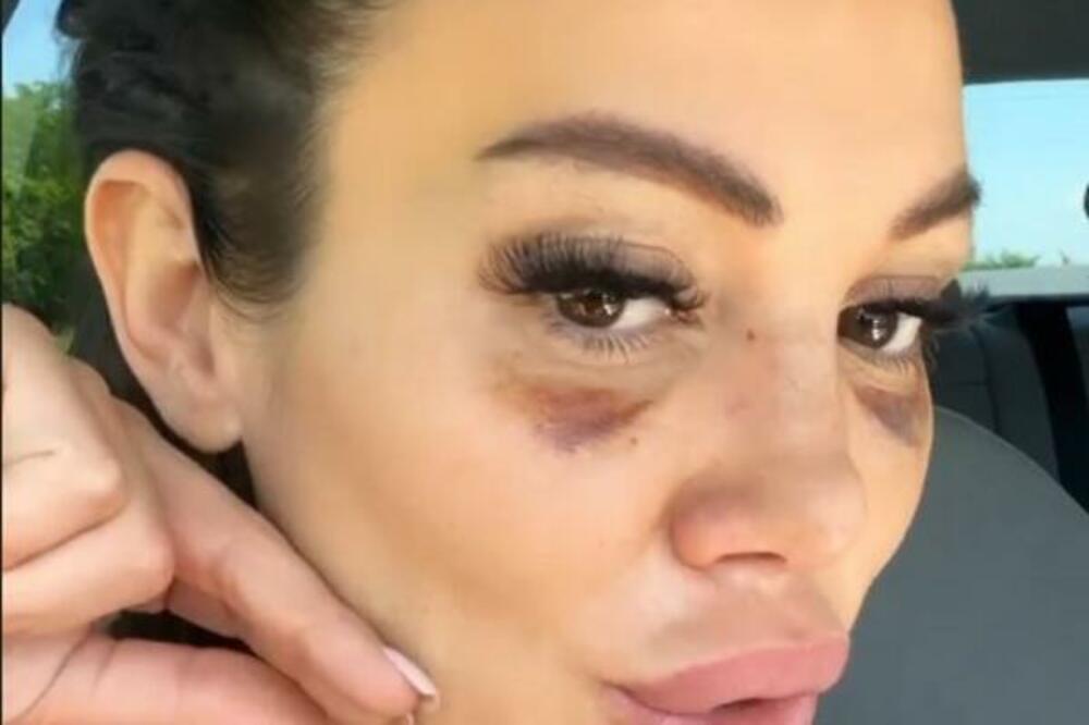 UZNEMIRUJUĆE SLIKE TAMARE ĐURIĆ! Sva u podlivima i modricama, ŠTA SE OVDE DESILO?! (FOTO)