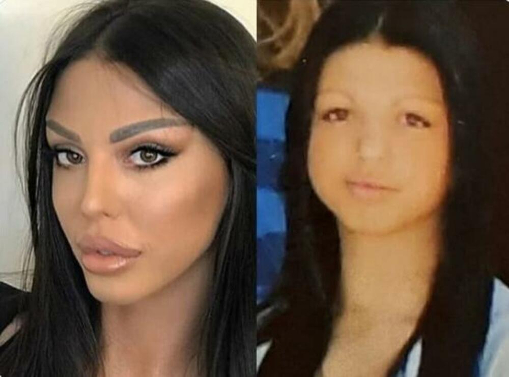 Maja Marinković pre plastičnih operacija