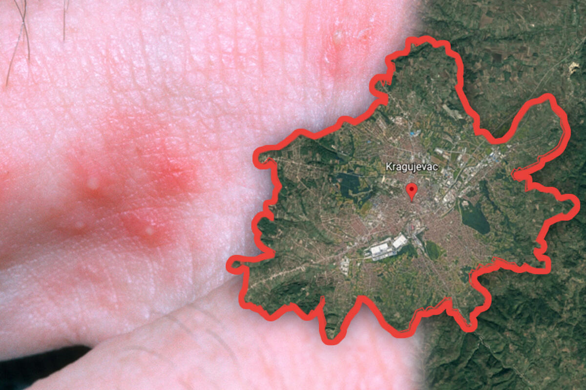 Evo kako se prenosi šuga!